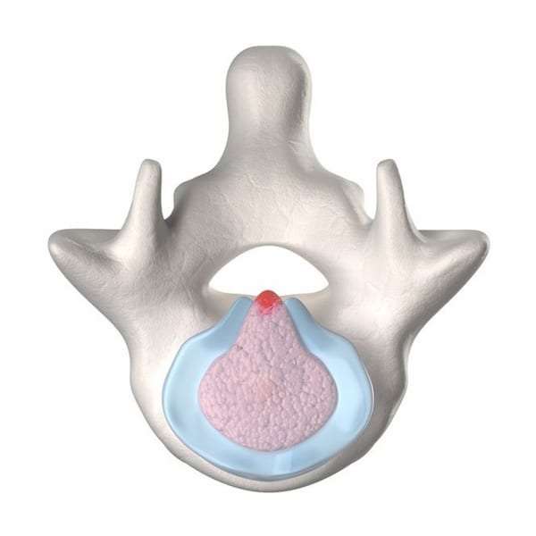 Extruded Disc Pain: The Symptoms, Causes, and Treatment