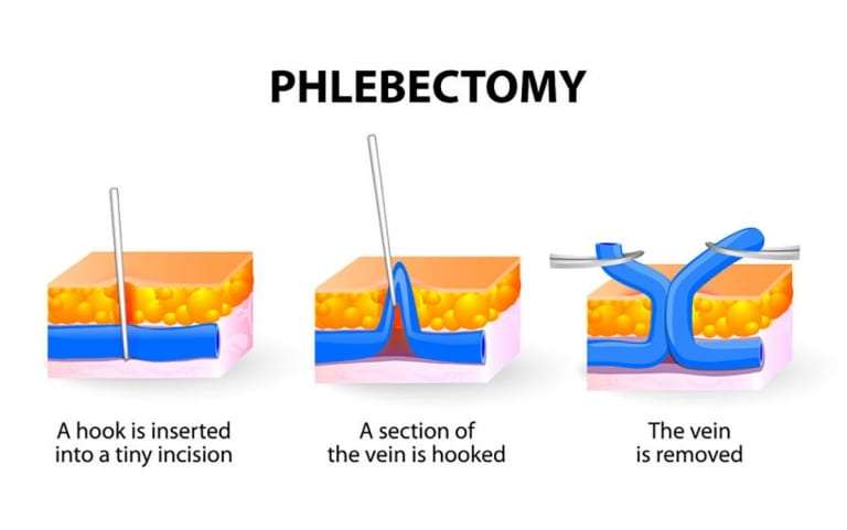 Phlebectomy: Minimally Invasive Varicose Vein Removal