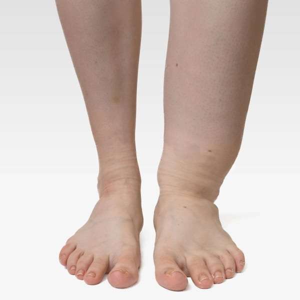 Edema: Causes, Symptoms, Treatments and Prevention