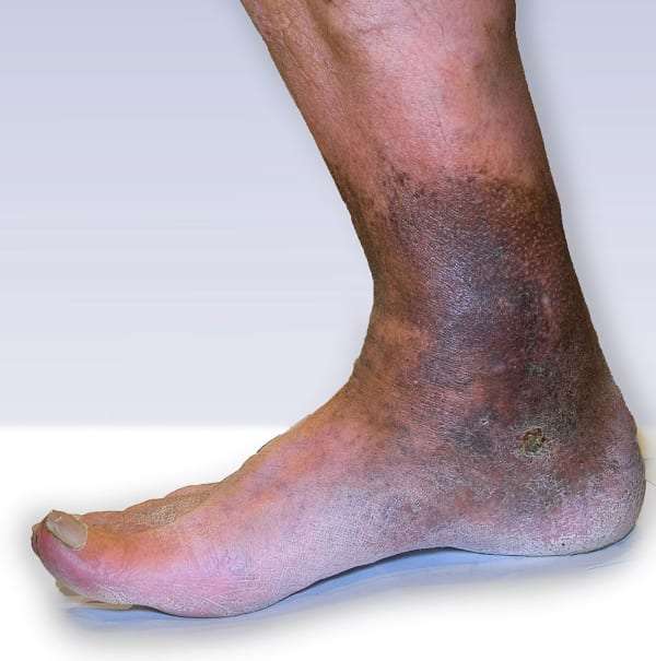 Venous Insufficiency: Causes, Symptoms and Treatment