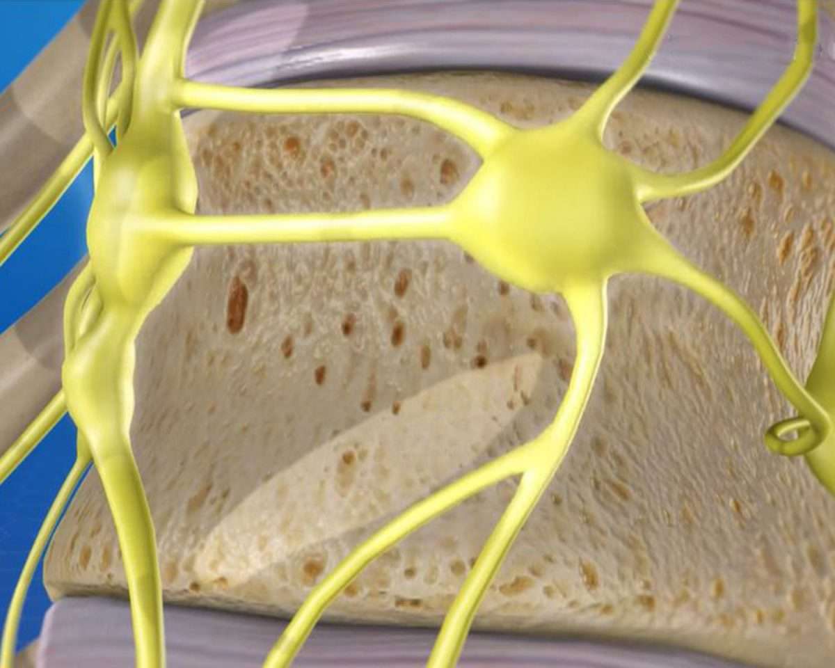 Nerve Block Image Gallery | Pain Treatments