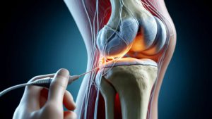 Genicular Nerve RFA for Chronic Knee Pain Relief