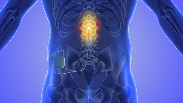 Neuromodulation: Innovative Pain Management Therapies